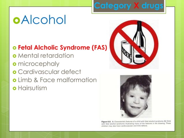 Teratology teratogenesis-birth defect-congenital malformation- anomaly ...
