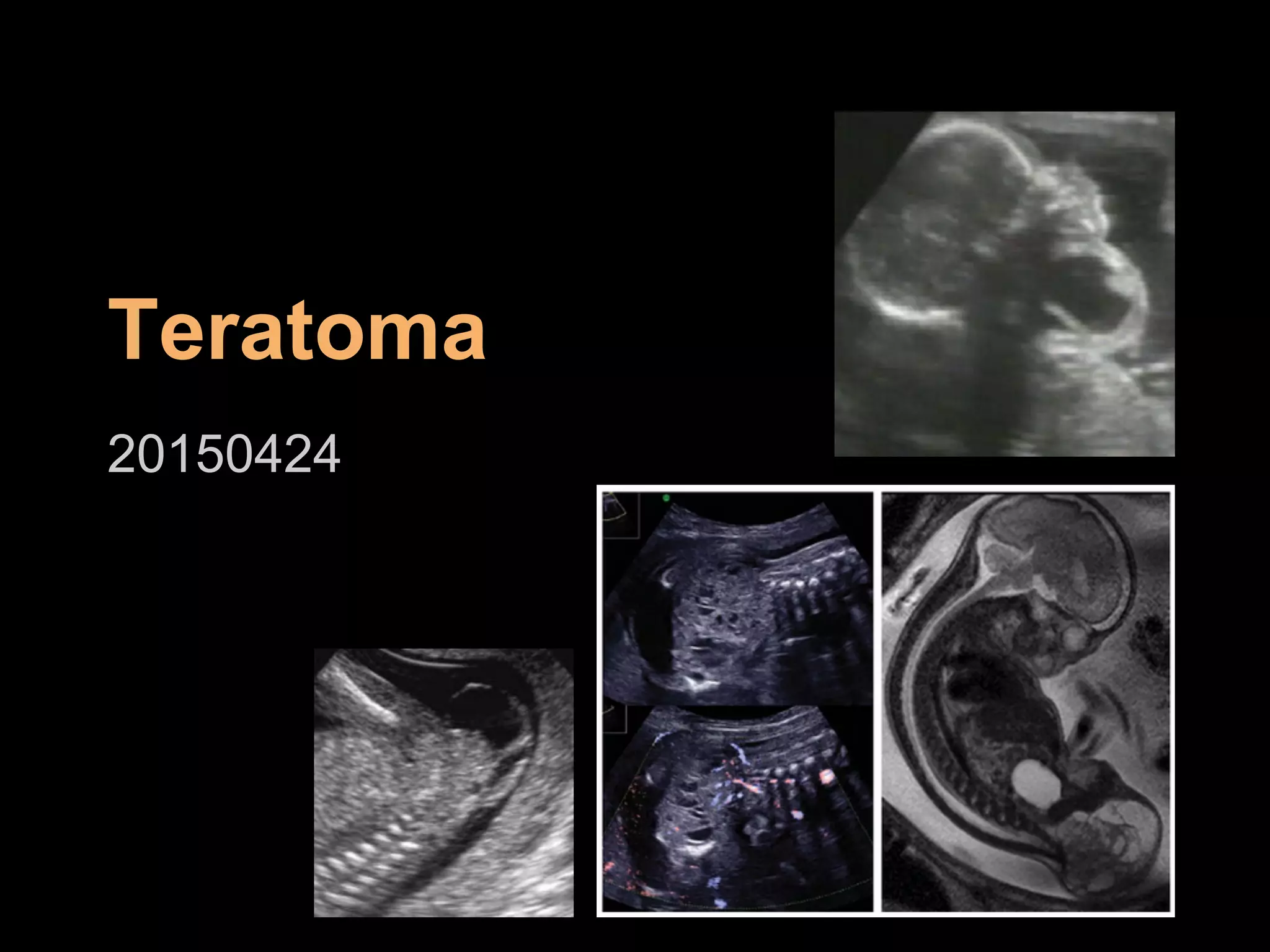 Teratoma | PDF