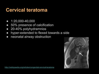 Teratoma | PDF