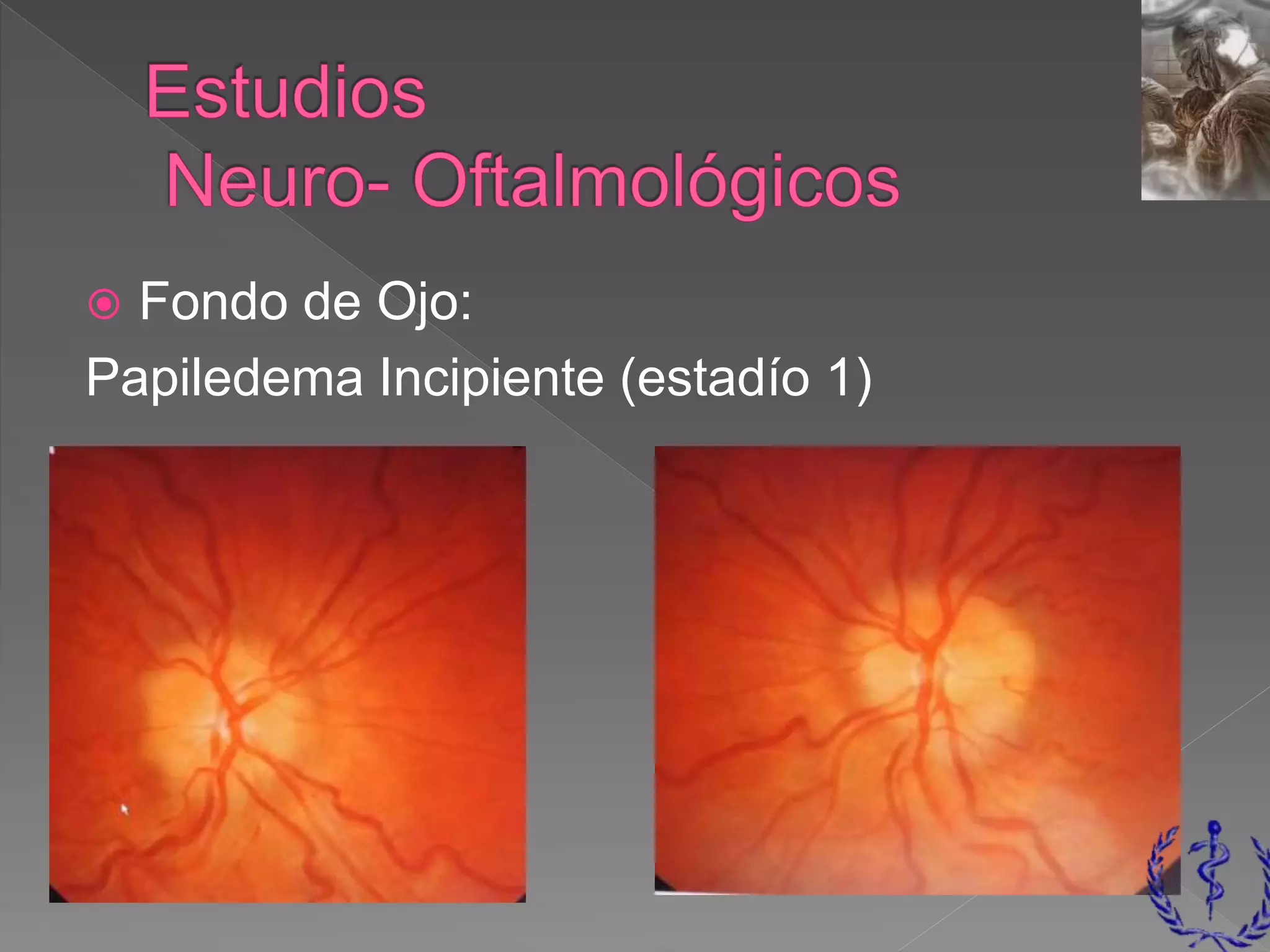 Tercer Ventriculostomía Endoscópica en un caso de Síndrome de Aicardi ...