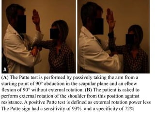 Teres minor tear test | PPT