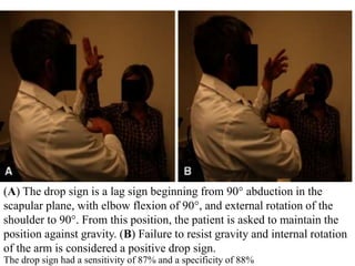 Teres minor tear test | PPT
