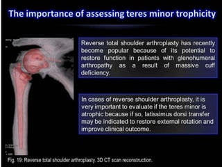 Teres minor tear test | PPT