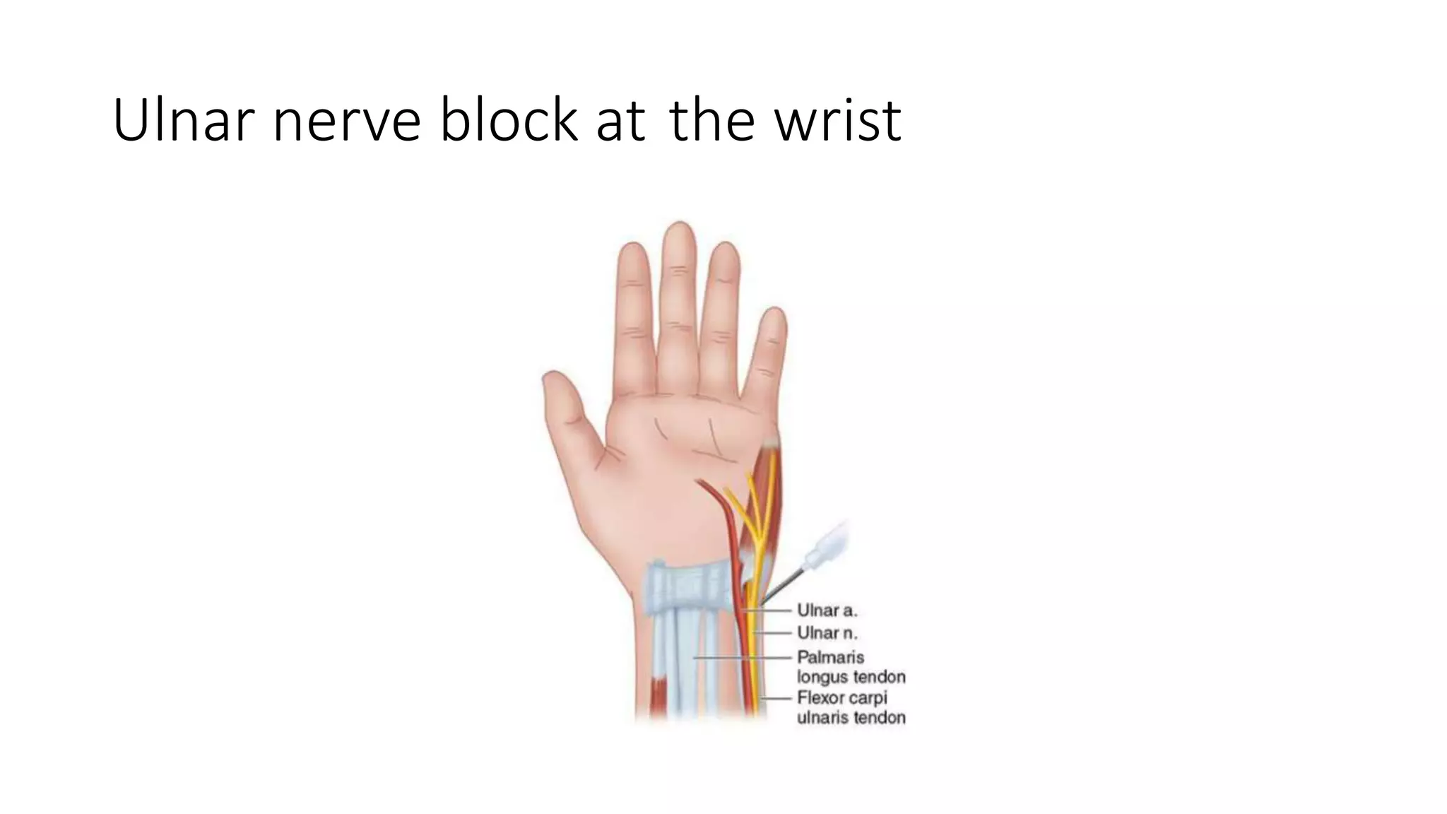 terminal nerve block.pptx