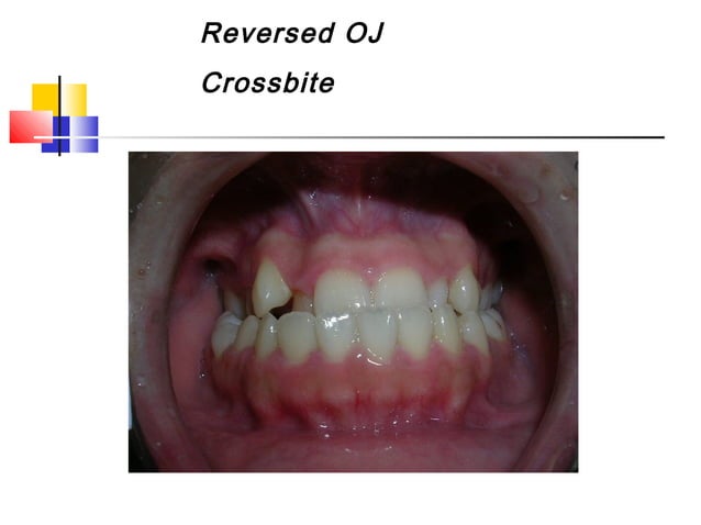 Terminology in Orthodontics | PPT | Dental Health | Diseases and Conditions