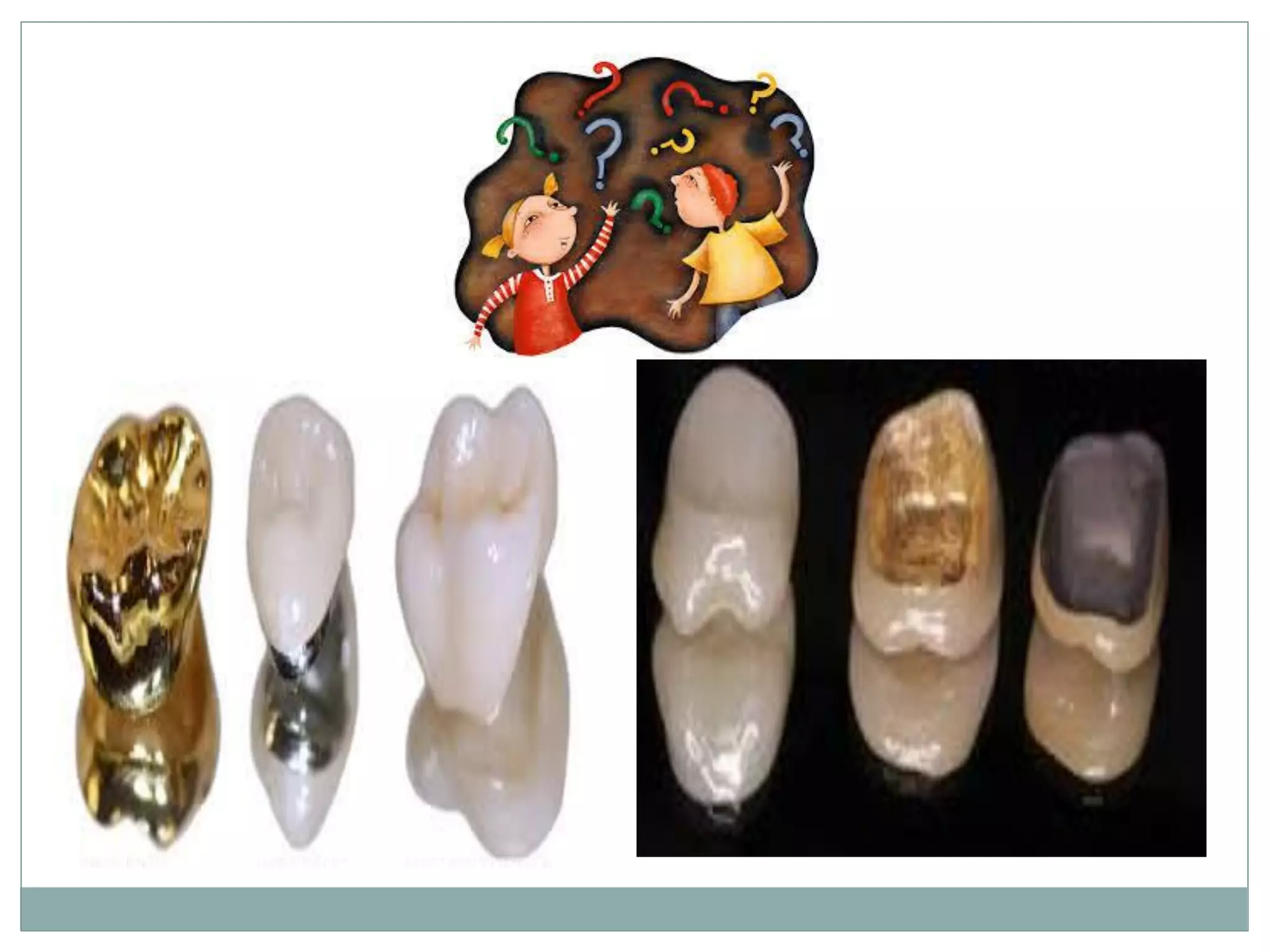 Terminology and classification of fixed prosthodontics | PDF
