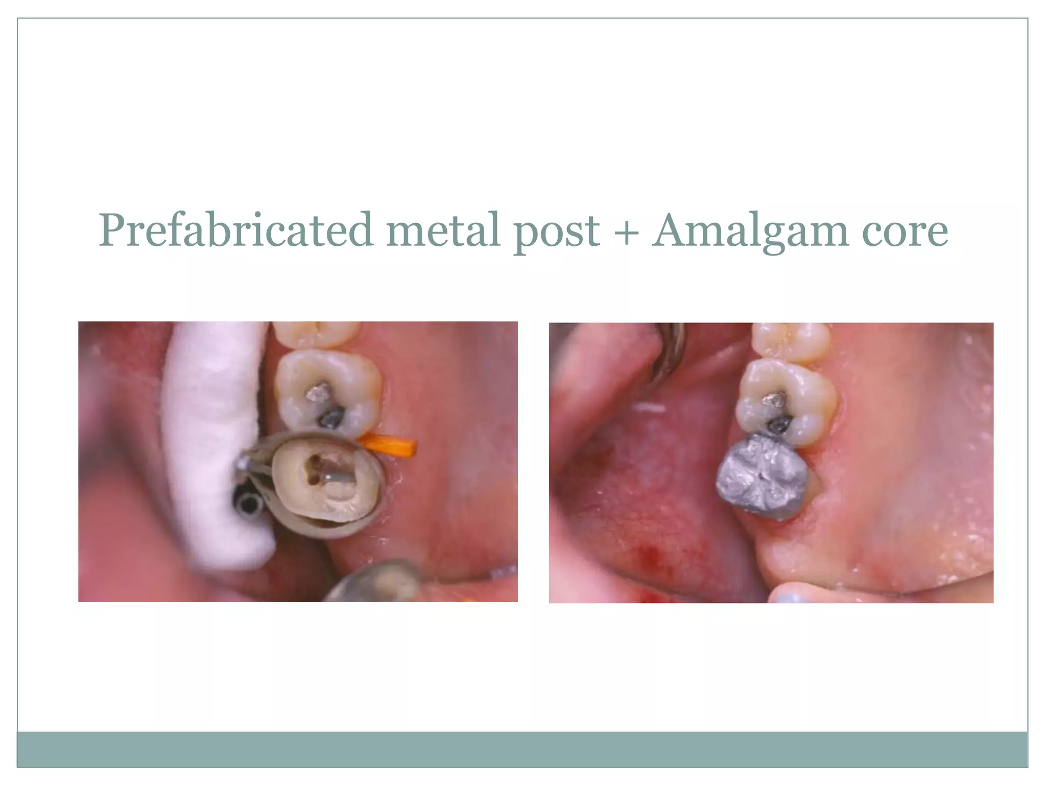 Terminology and classification of fixed prosthodontics | PDF