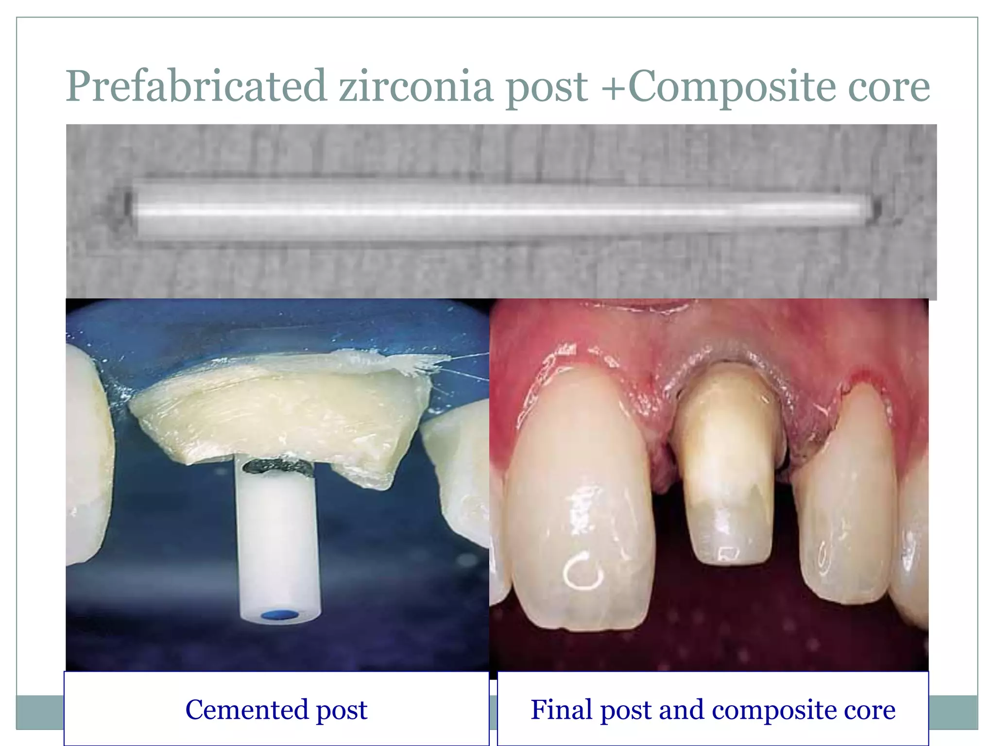 Terminology and classification of fixed prosthodontics | PDF