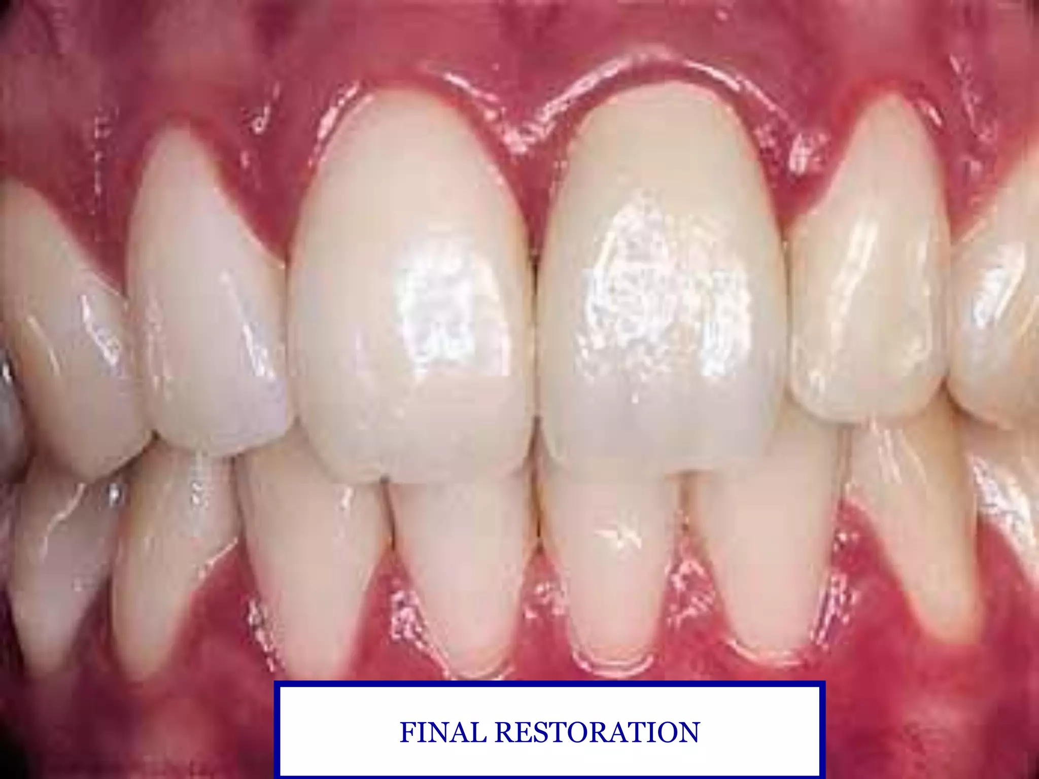 Terminology and classification of fixed prosthodontics | PDF