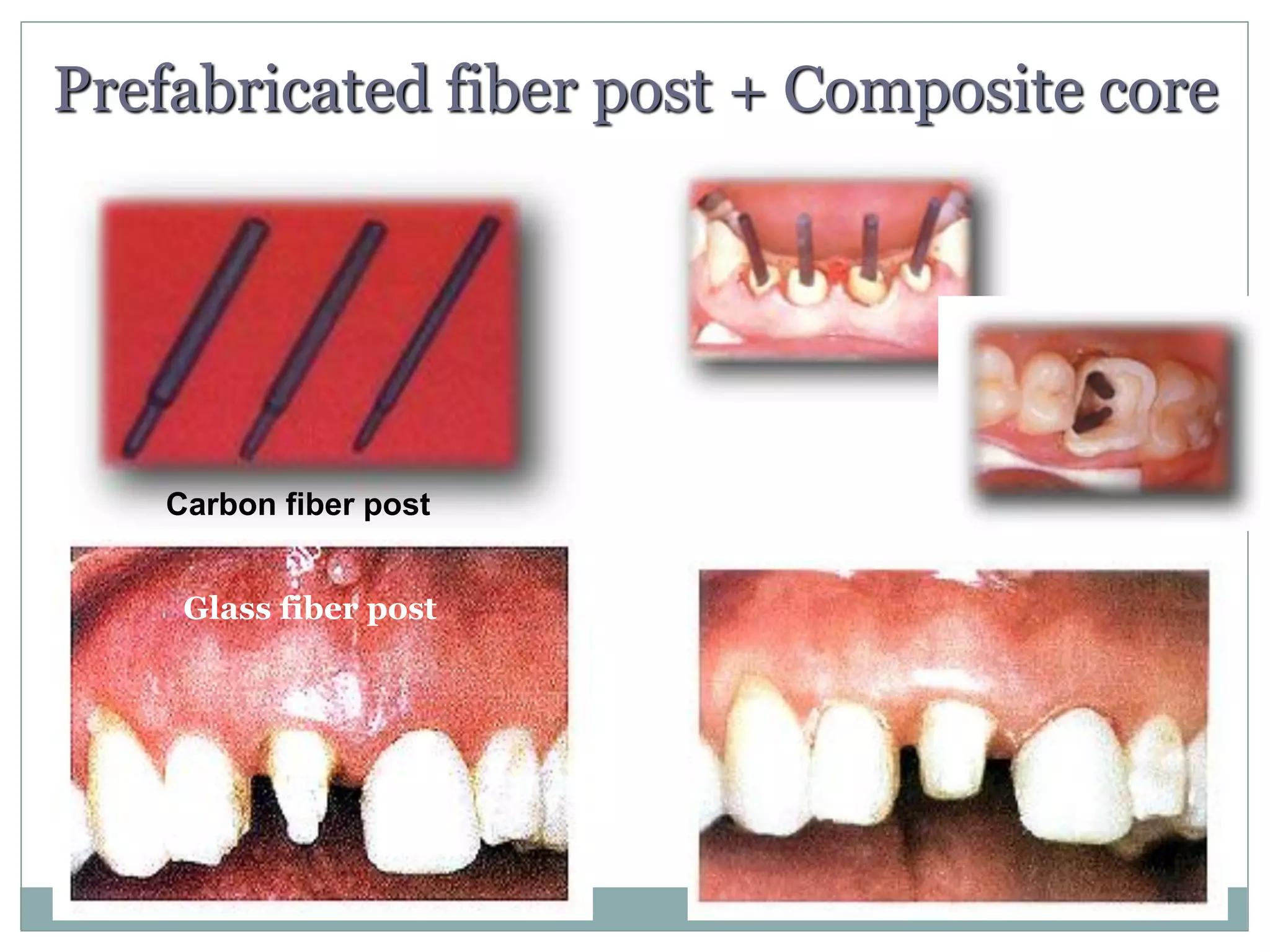 Terminology and classification of fixed prosthodontics | PDF