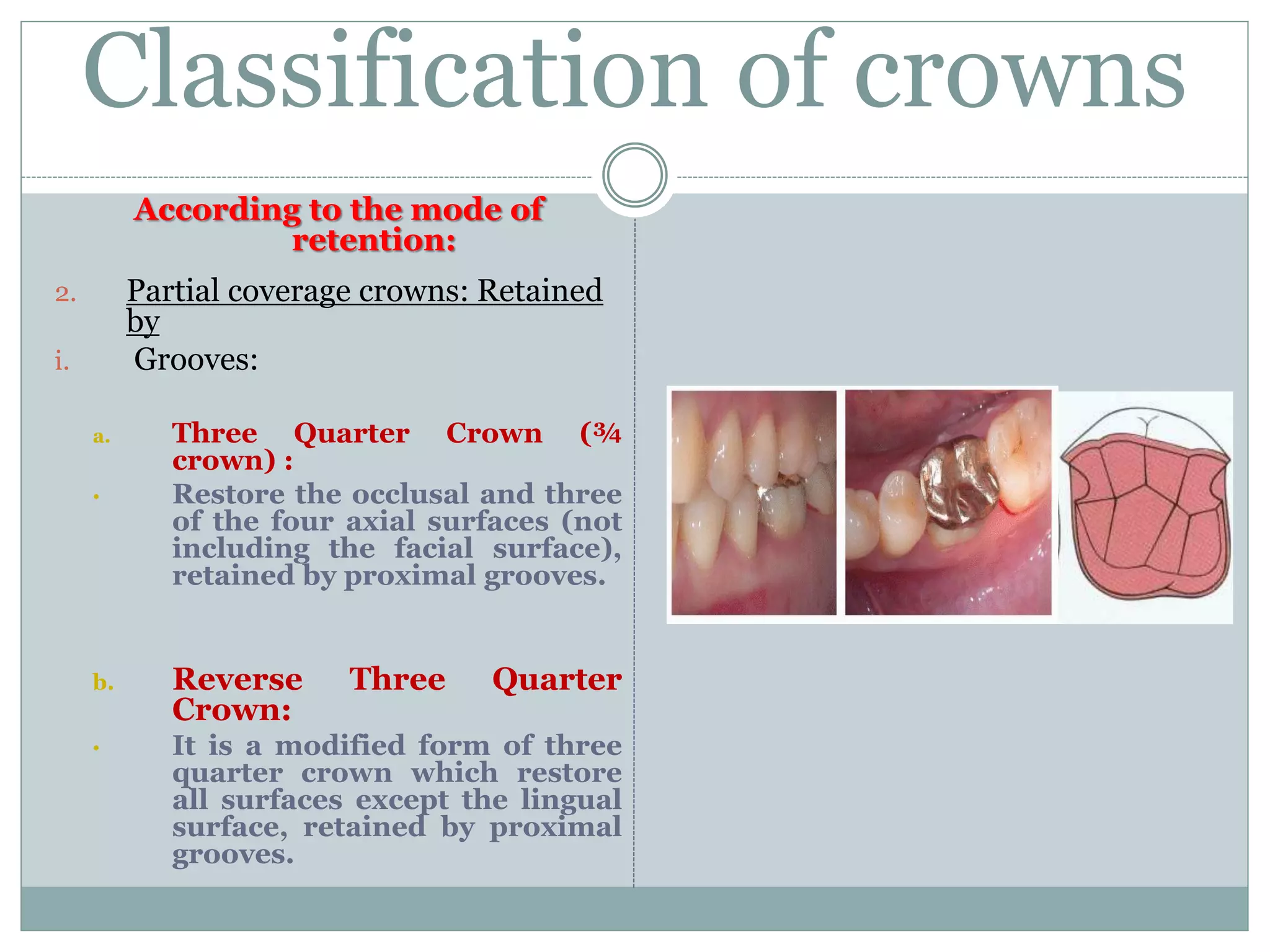 Terminology and classification of fixed prosthodontics | PDF