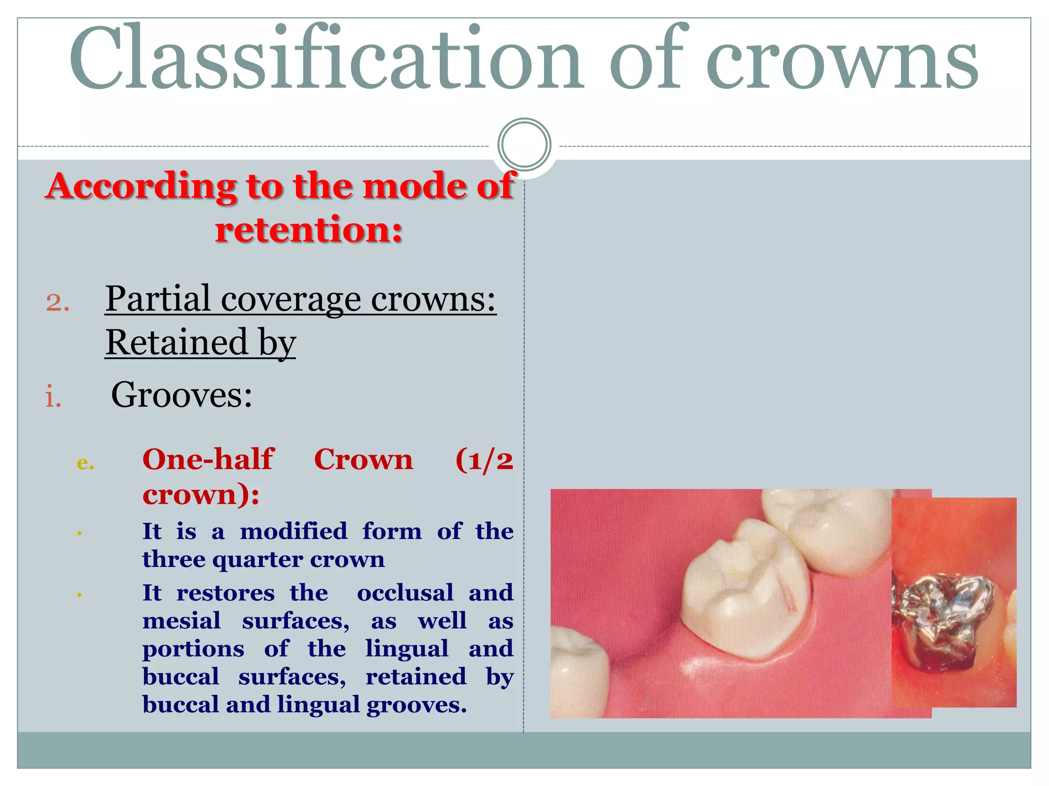 Terminology and classification of fixed prosthodontics | PDF