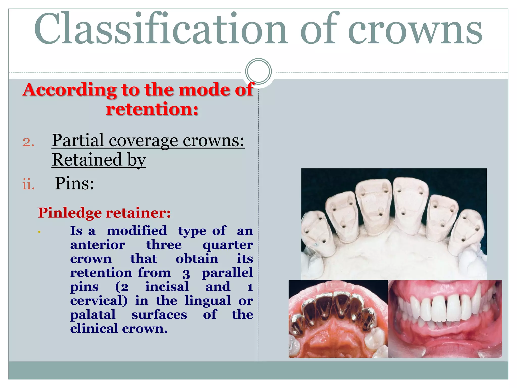 Terminology and classification of fixed prosthodontics | PDF