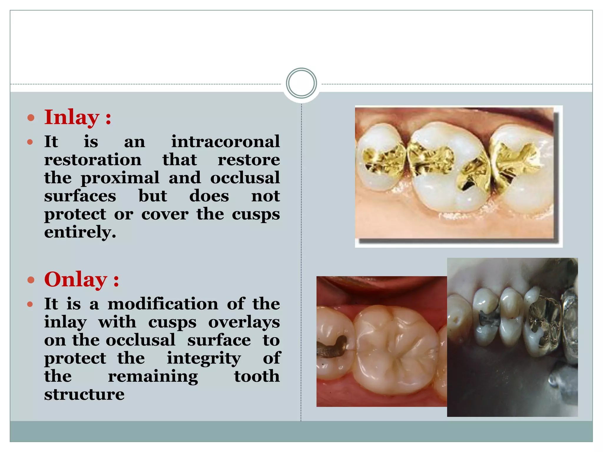Terminology and classification of fixed prosthodontics | PDF