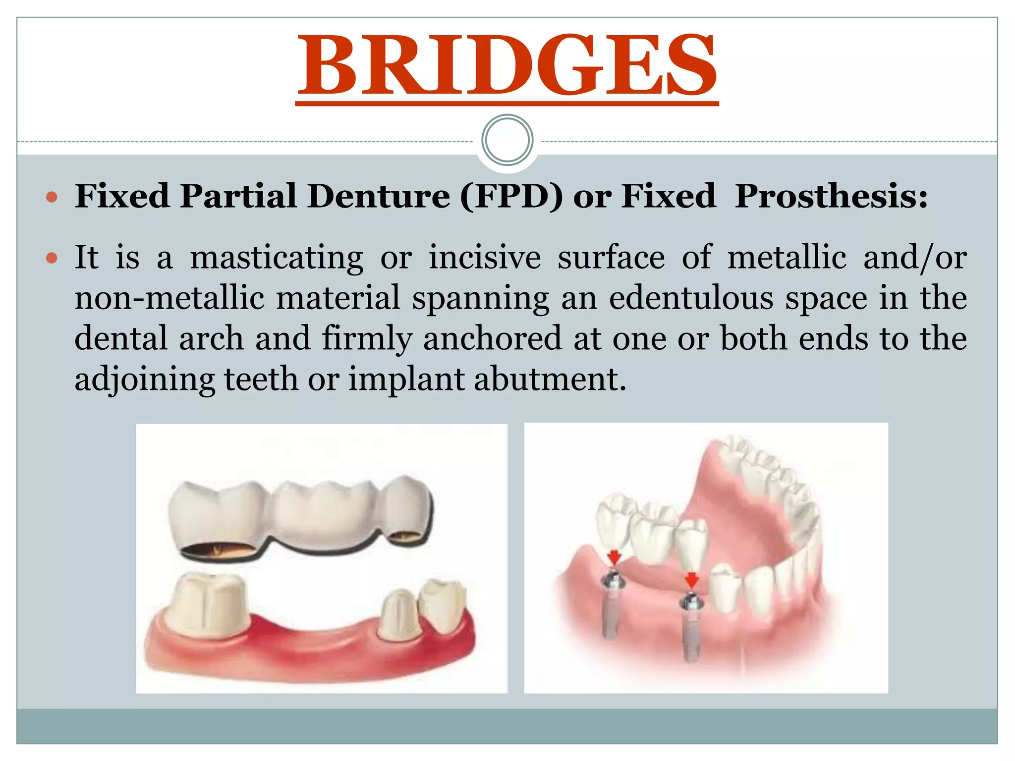 Terminology and classification of fixed prosthodontics | PDF