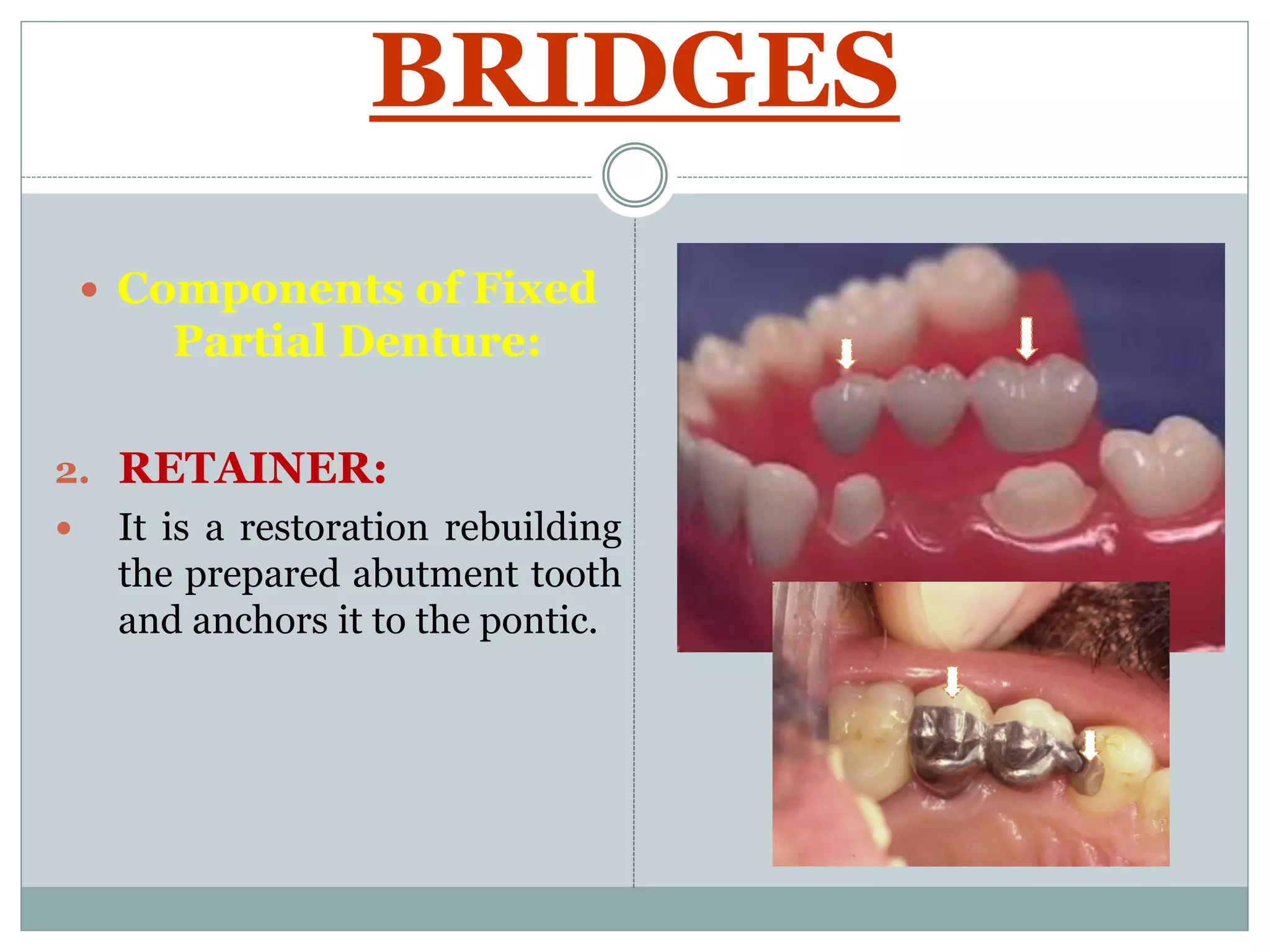 Terminology and classification of fixed prosthodontics | PDF
