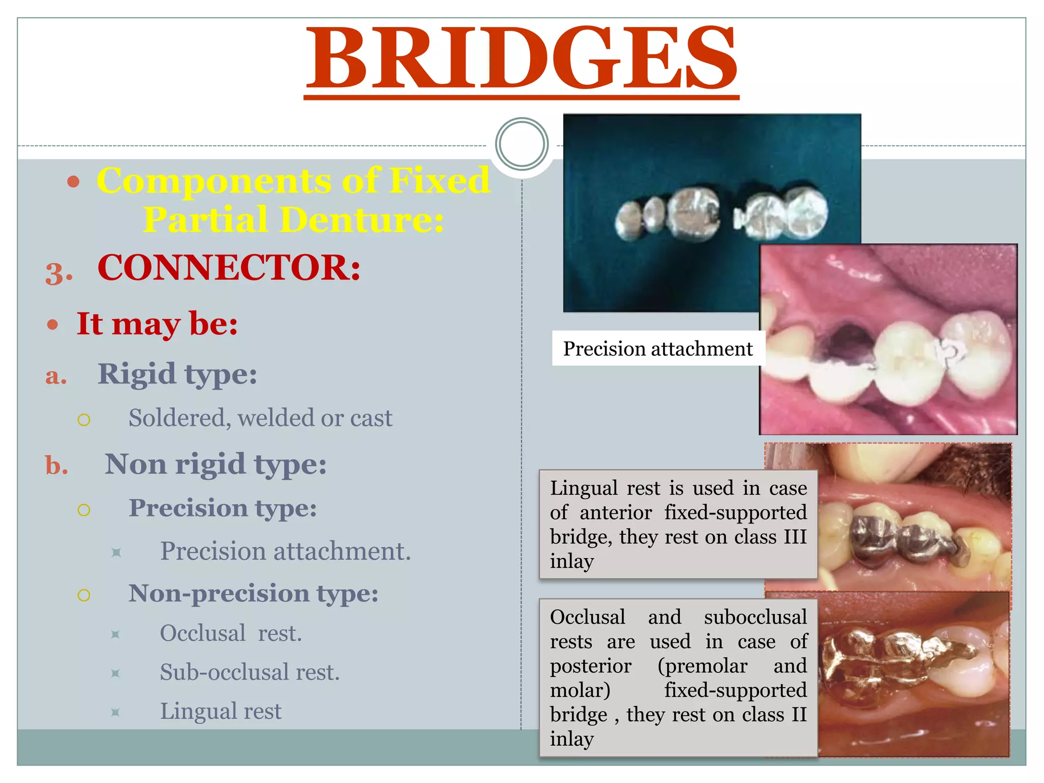Terminology and classification of fixed prosthodontics | PDF