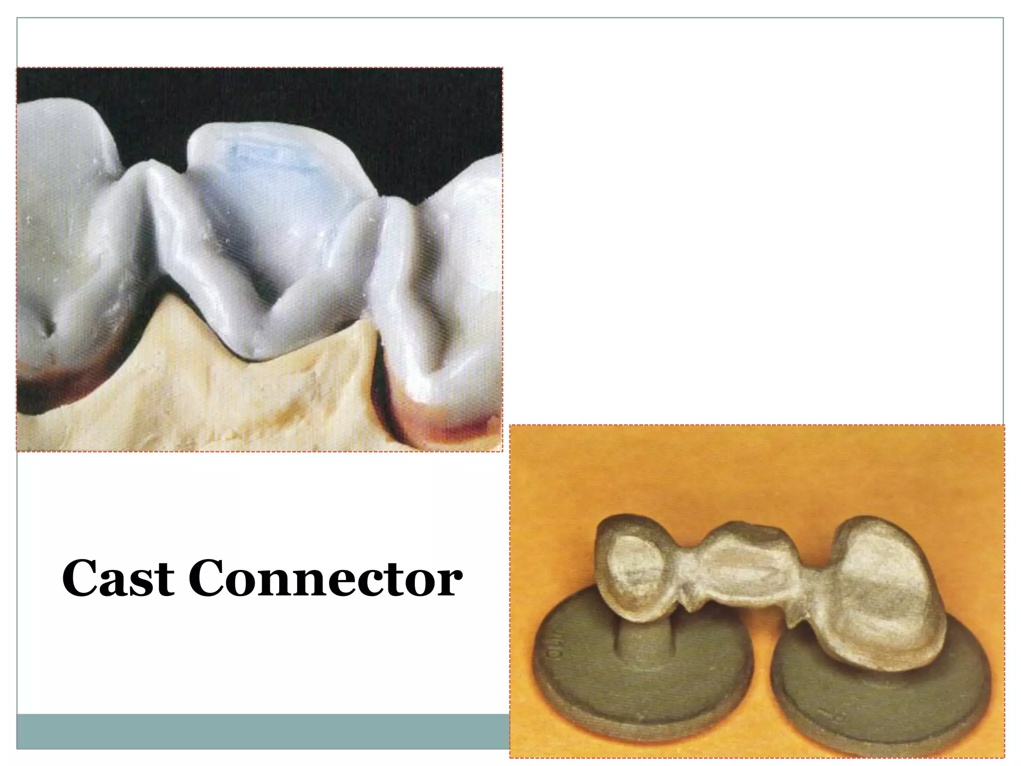Terminology and classification of fixed prosthodontics | PDF