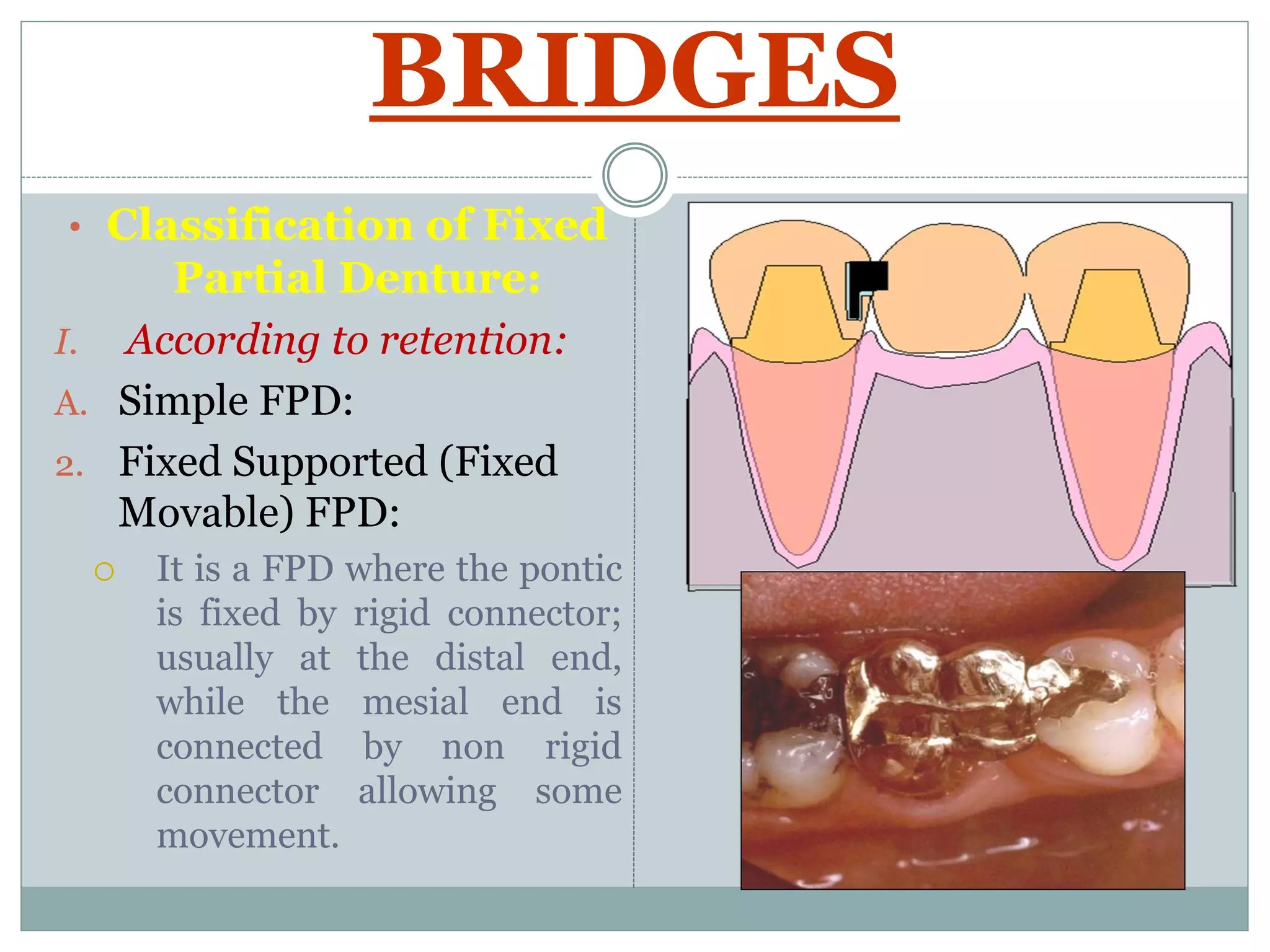 Terminology and classification of fixed prosthodontics | PDF