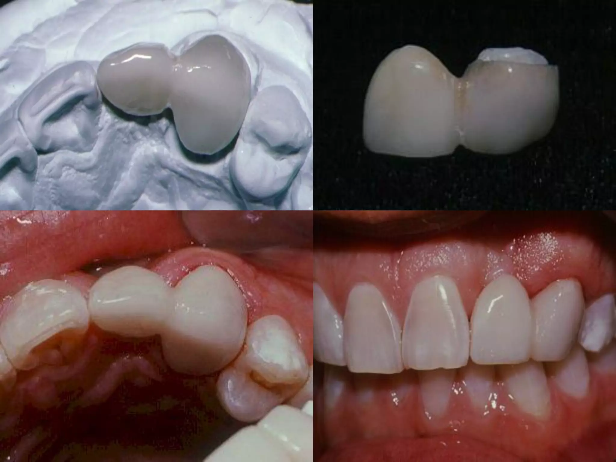 Terminology and classification of fixed prosthodontics | PDF