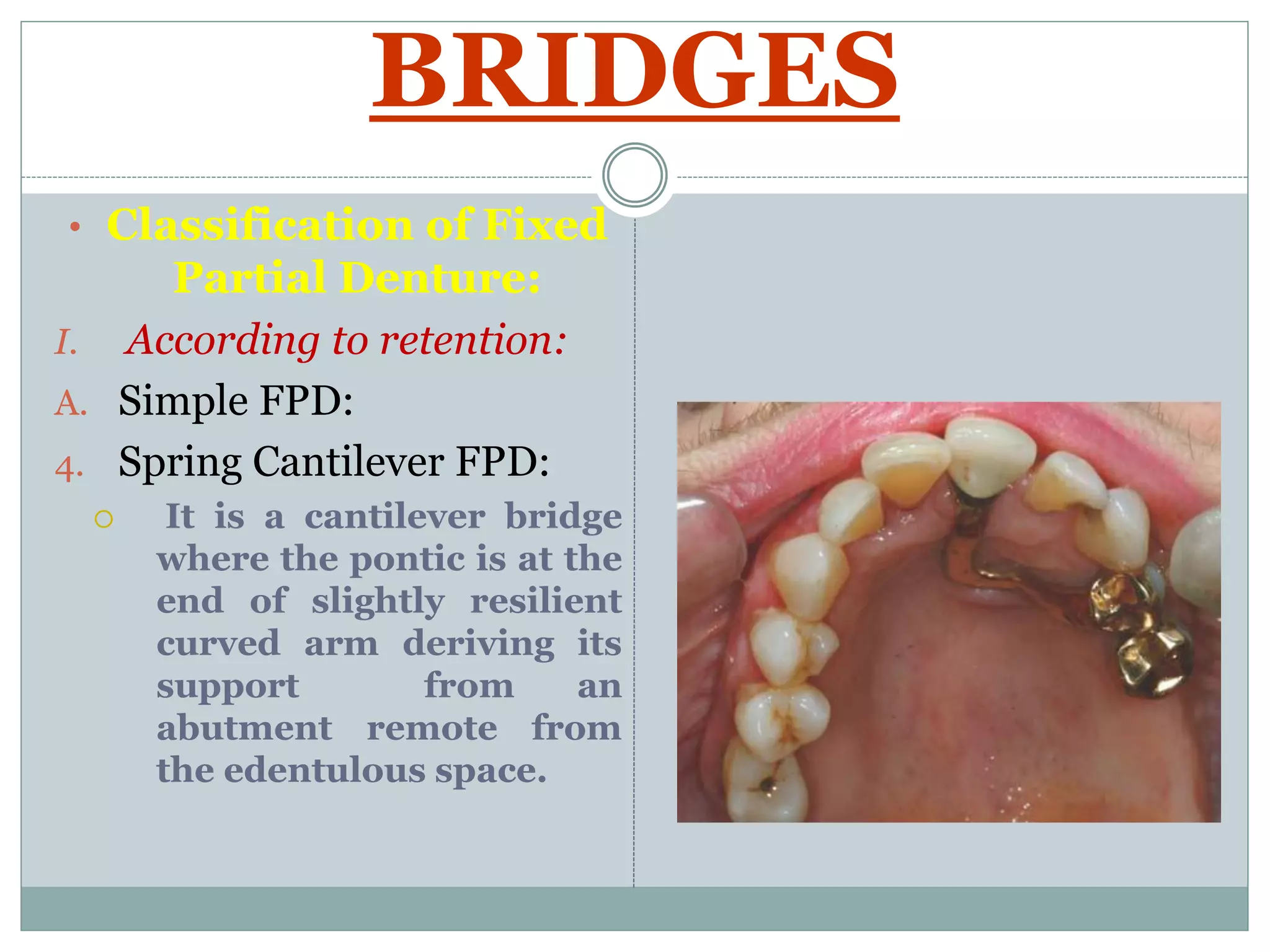 Terminology and classification of fixed prosthodontics | PDF