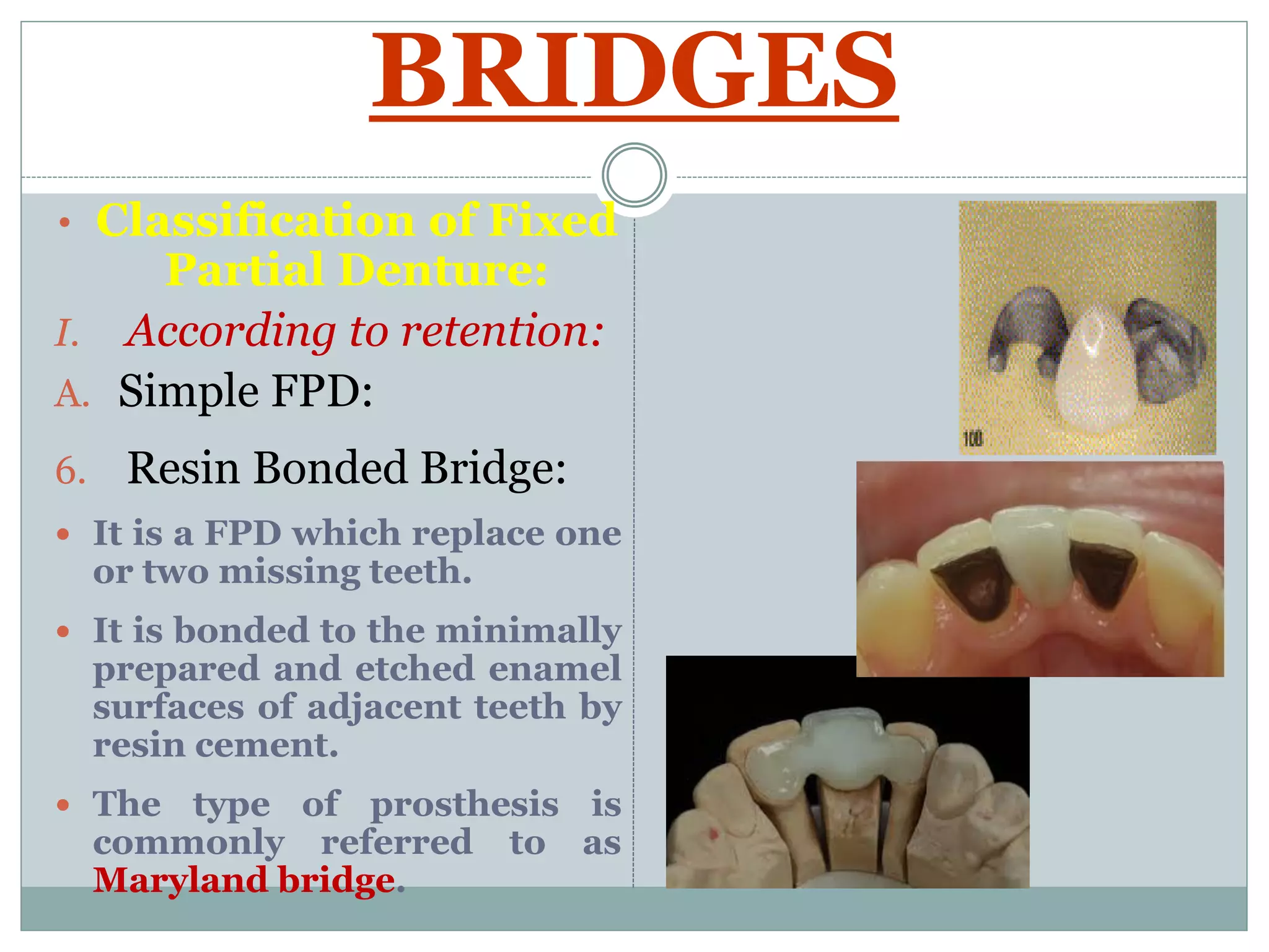 Terminology and classification of fixed prosthodontics | PDF
