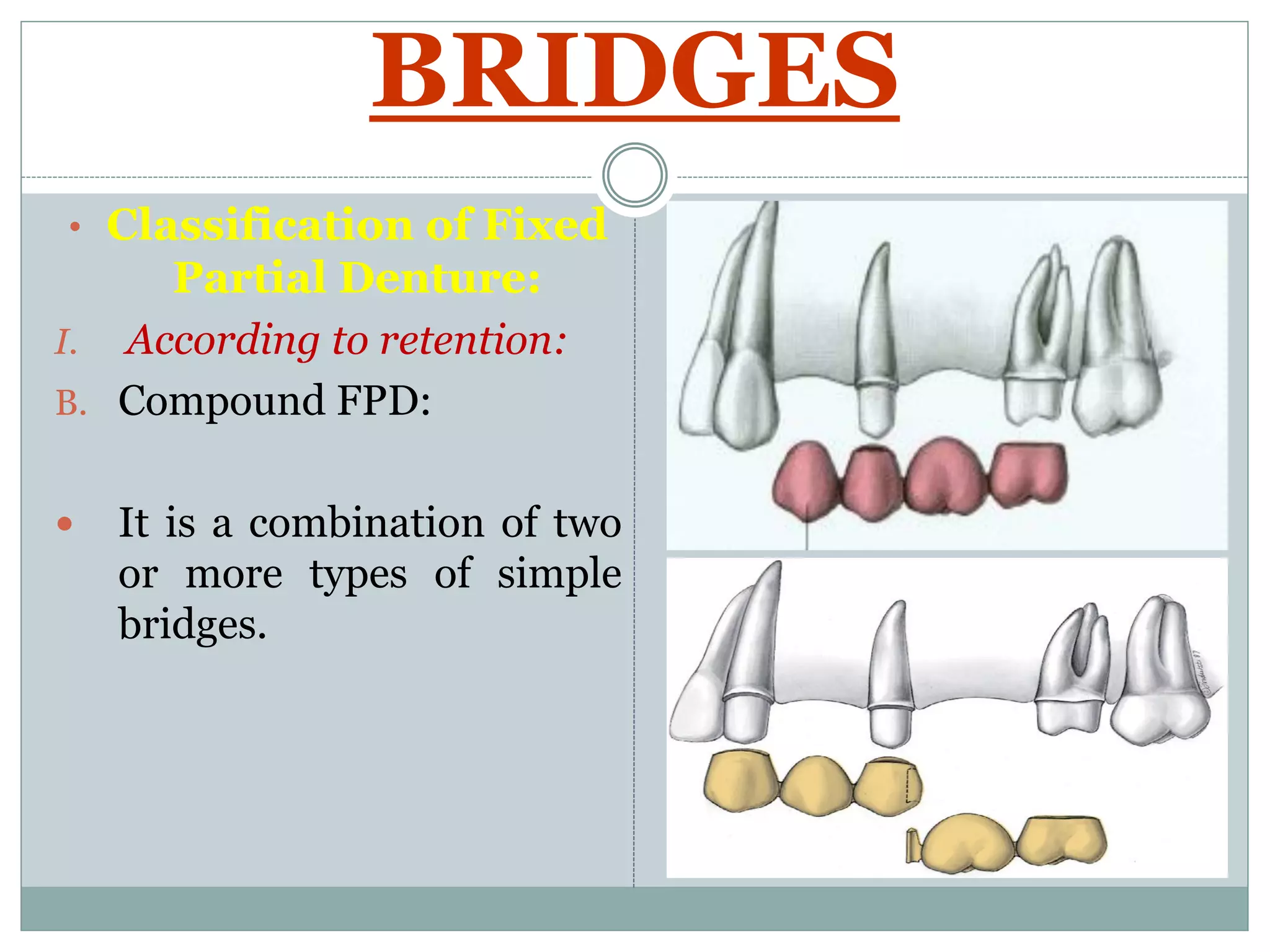 Terminology and classification of fixed prosthodontics | PDF