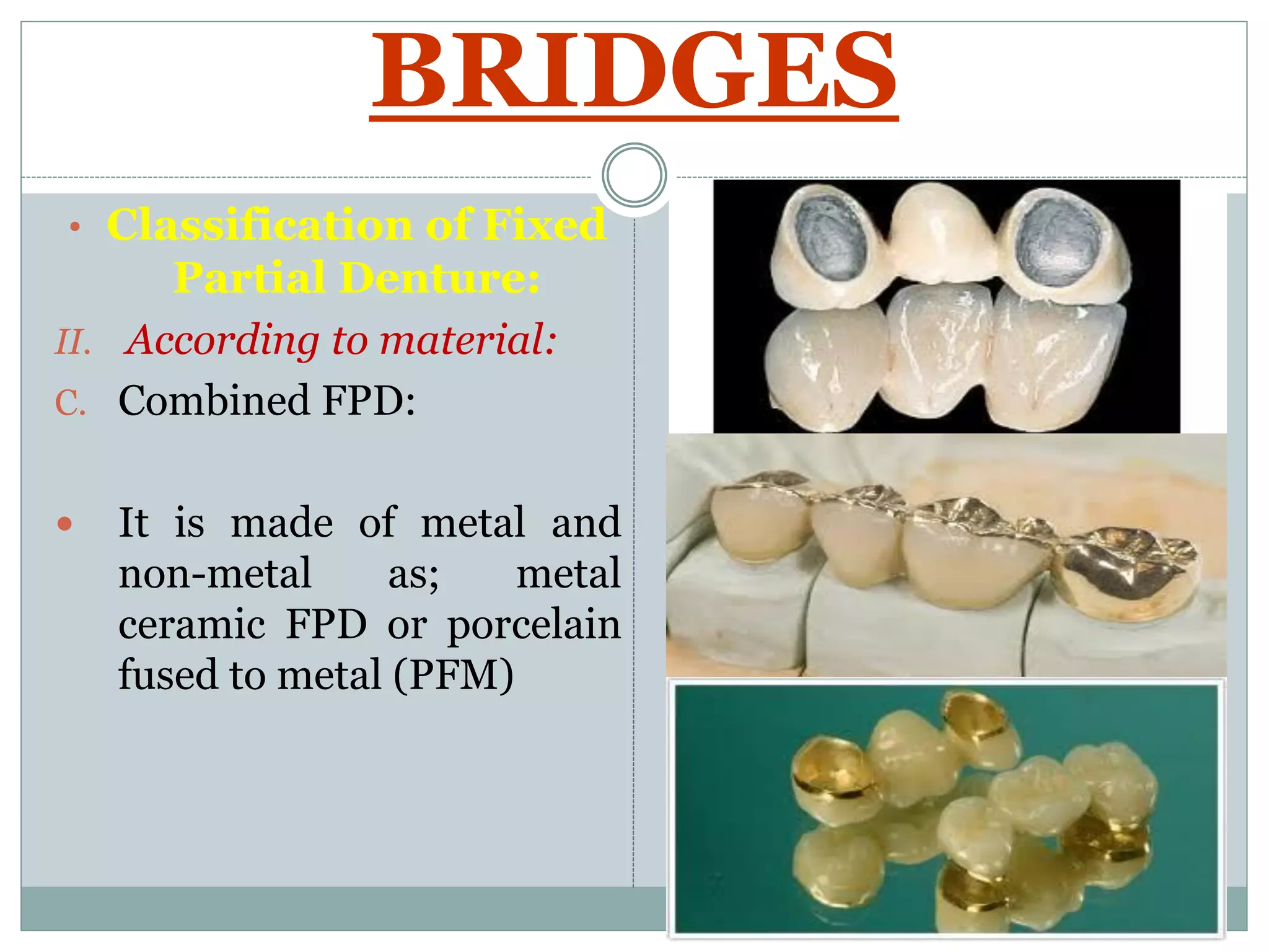 Terminology and classification of fixed prosthodontics | PDF