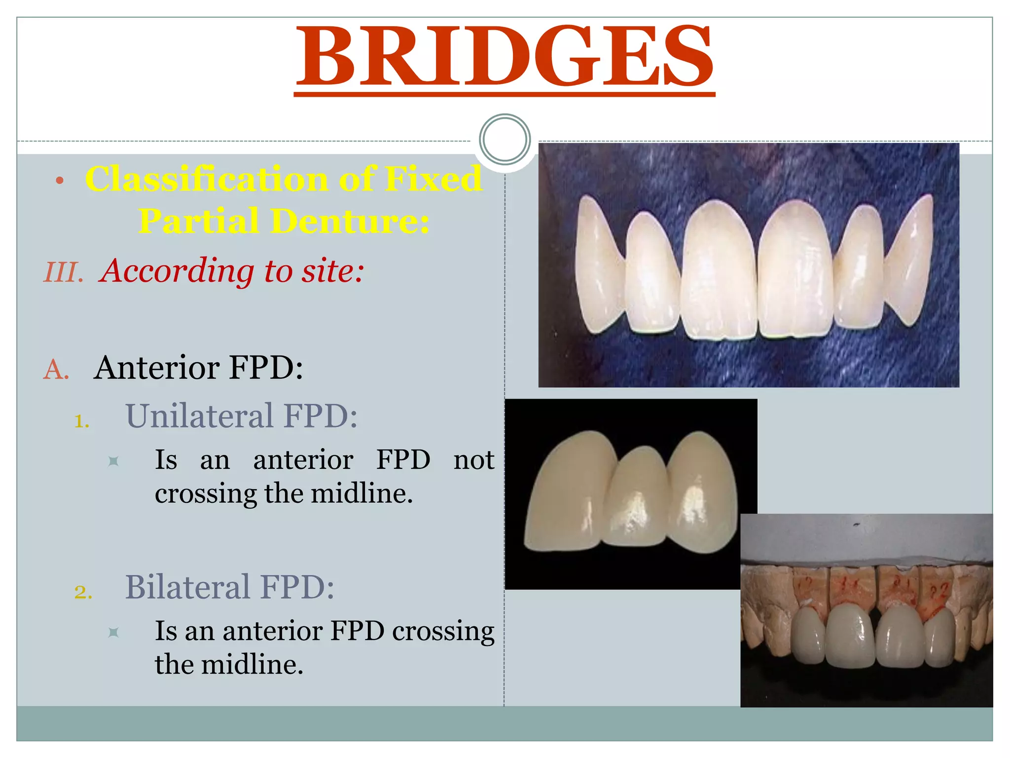 Terminology and classification of fixed prosthodontics | PDF