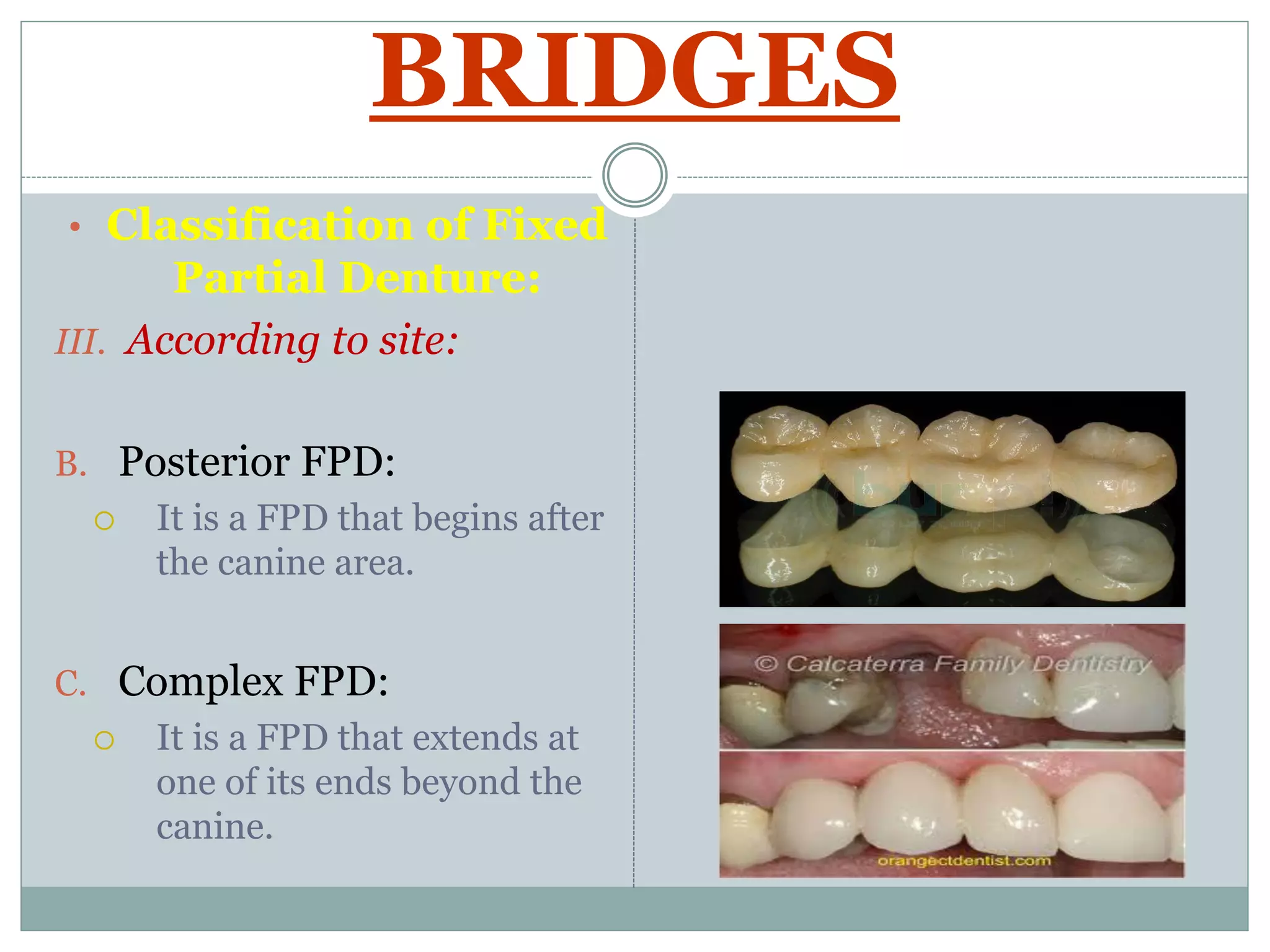 Terminology and classification of fixed prosthodontics | PDF