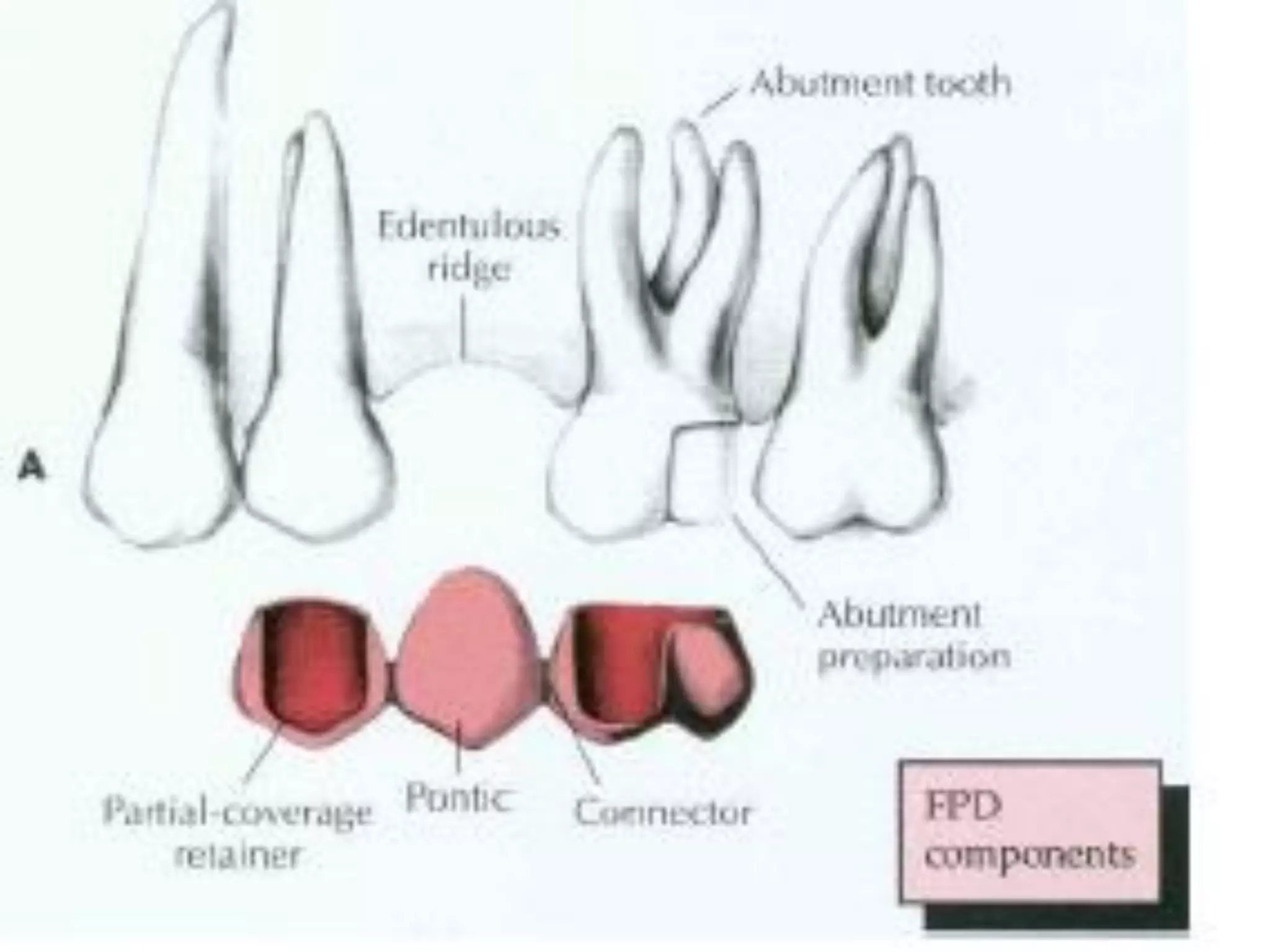 Terminology and classification of fixed prosthodontics | PDF