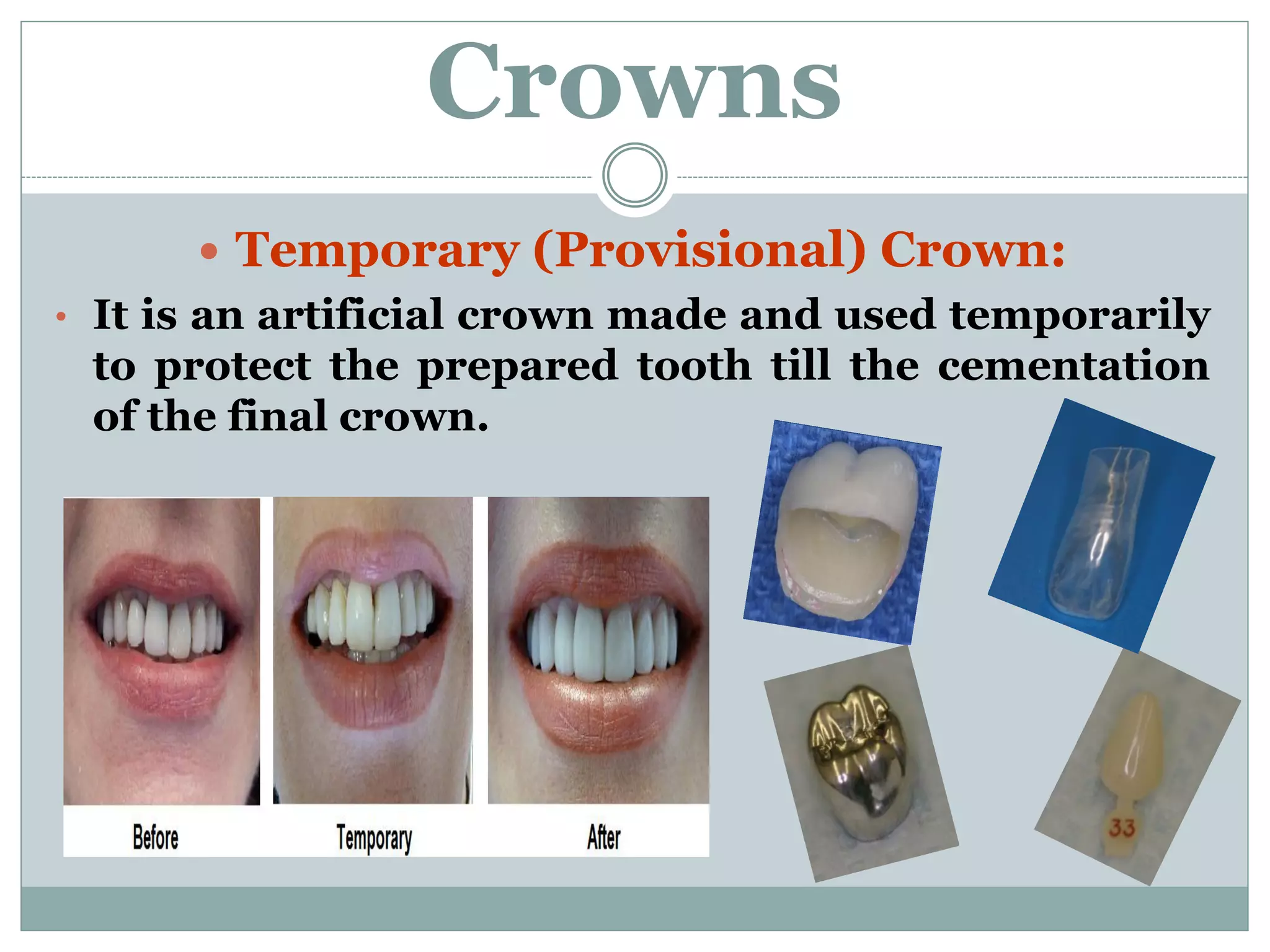 Terminology and classification of fixed prosthodontics | PDF