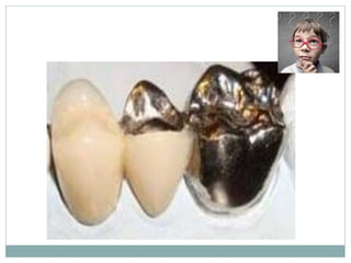 Terminology and classification of fixed prosthodontics | PDF