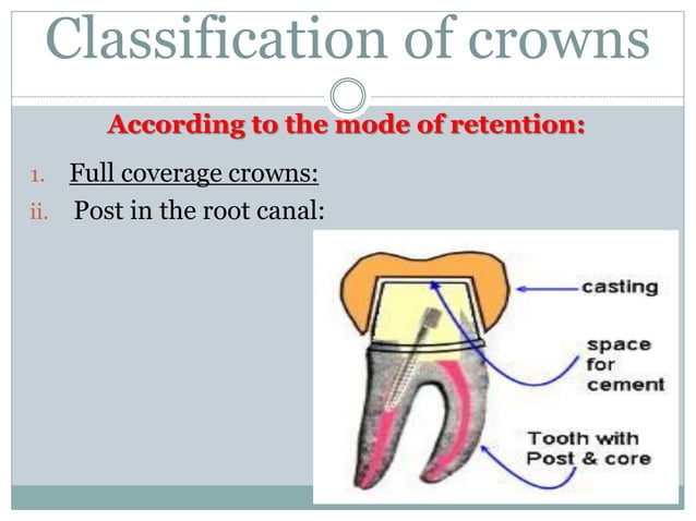 Terminology and classification of fixed prosthodontics | PDF | Oral ...