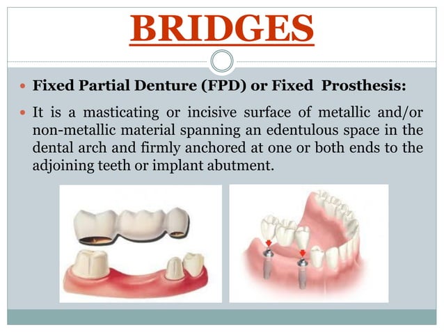 Terminology and classification of fixed prosthodontics | PDF | Oral ...
