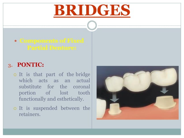 Terminology and classification of fixed prosthodontics | PDF | Oral ...