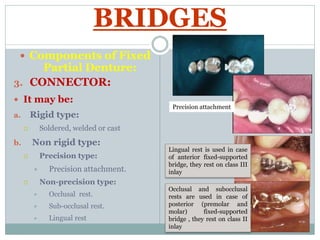 Terminology and classification of fixed prosthodontics | PDF
