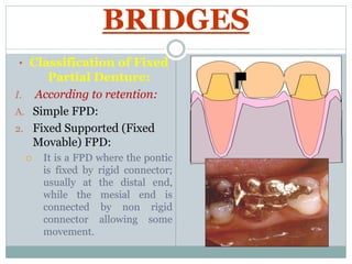 Terminology and classification of fixed prosthodontics | PDF