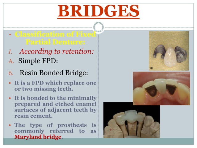 Terminology and classification of fixed prosthodontics | PDF | Oral ...