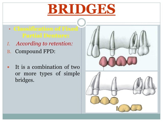 Terminology and classification of fixed prosthodontics | PDF | Oral ...