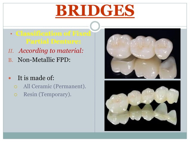 Terminology and classification of fixed prosthodontics | PDF | Oral ...