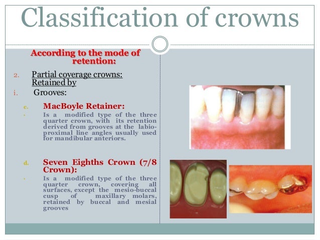 Terminology and classification of fixed prosthodontics