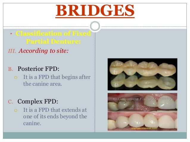 Terminology and classification of fixed prosthodontics