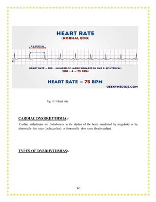 Term paper on ECG and cardiac arrhythmias | DOCX