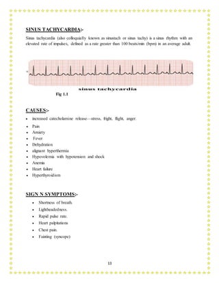 Term paper on ECG and cardiac arrhythmias | DOCX