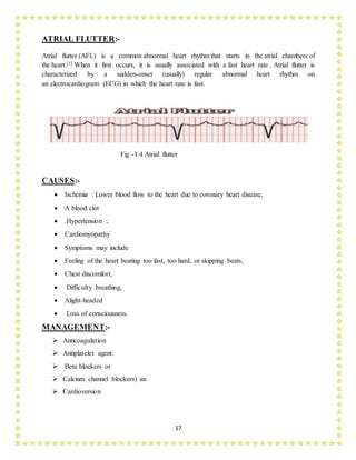 Term paper on ECG and cardiac arrhythmias | PDF