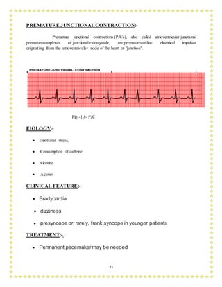 Term paper on ECG and cardiac arrhythmias | PDF