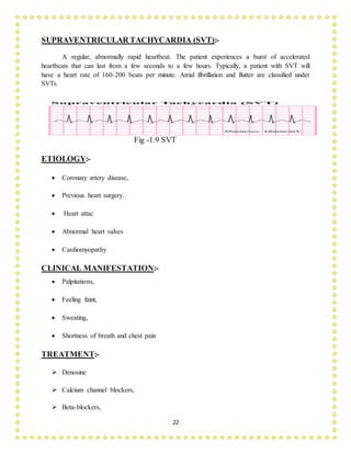 Term paper on ECG and cardiac arrhythmias | PDF