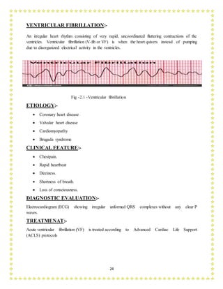 Term paper on ECG and cardiac arrhythmias | DOCX