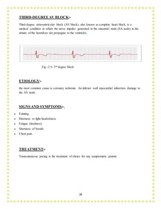 Term paper on ECG and cardiac arrhythmias | PDF